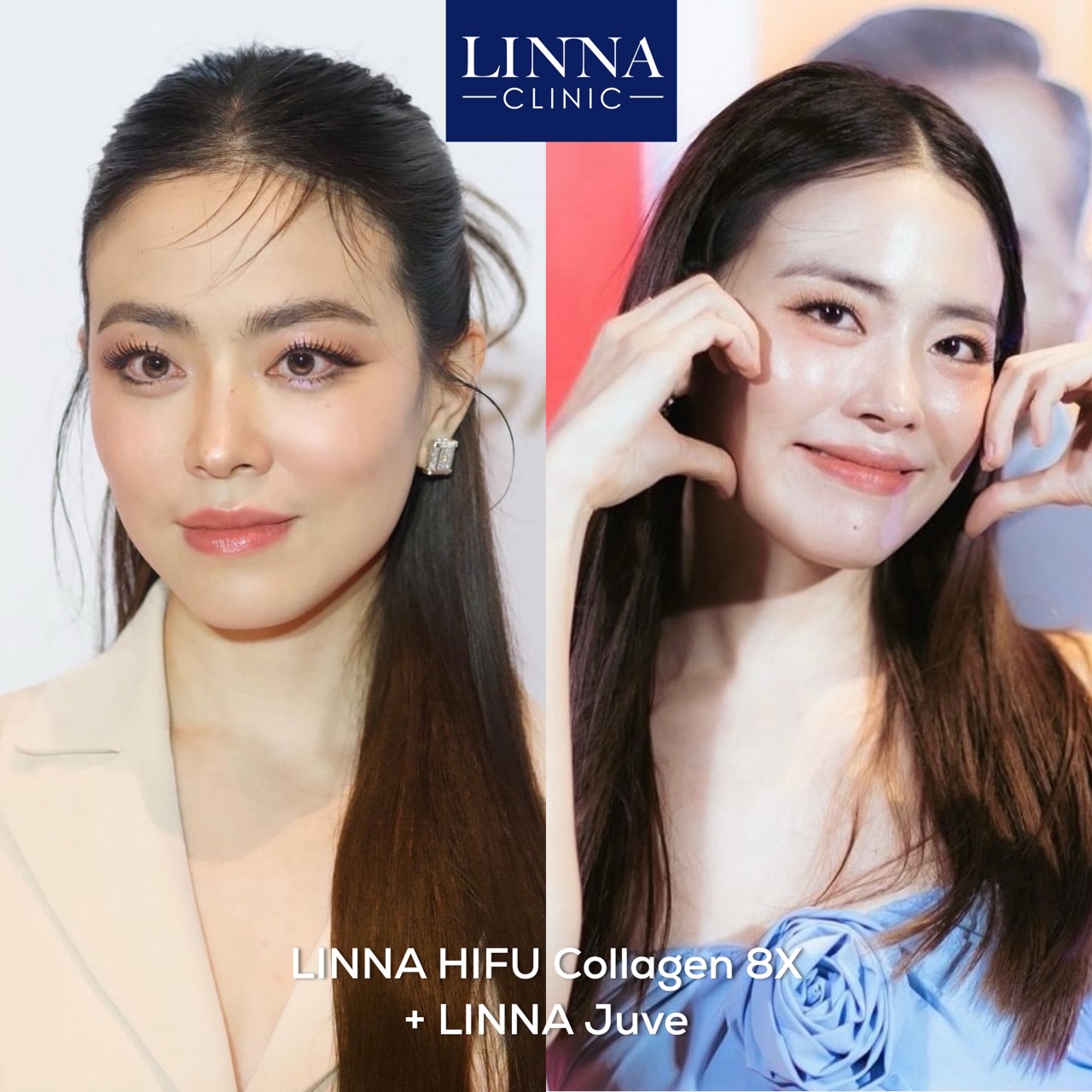 ลินนา คลินิก | LINNA CLINIC | Linna 童颜针 - LINNA CLINIC